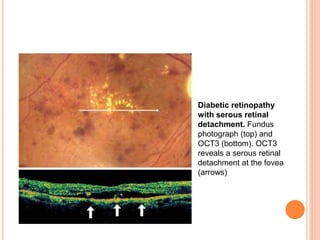 Optical Coherence Tomography(OCT) in posterior segment diseases | PPT