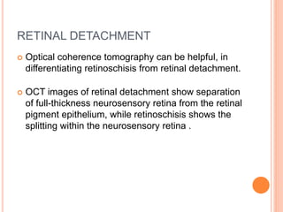 Optical Coherence Tomography(OCT) in posterior segment diseases | PPT