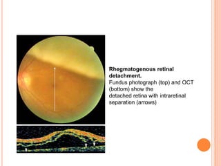 Optical Coherence Tomography(OCT) in posterior segment diseases | PPT