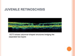 Optical Coherence Tomography(OCT) in posterior segment diseases | PPT
