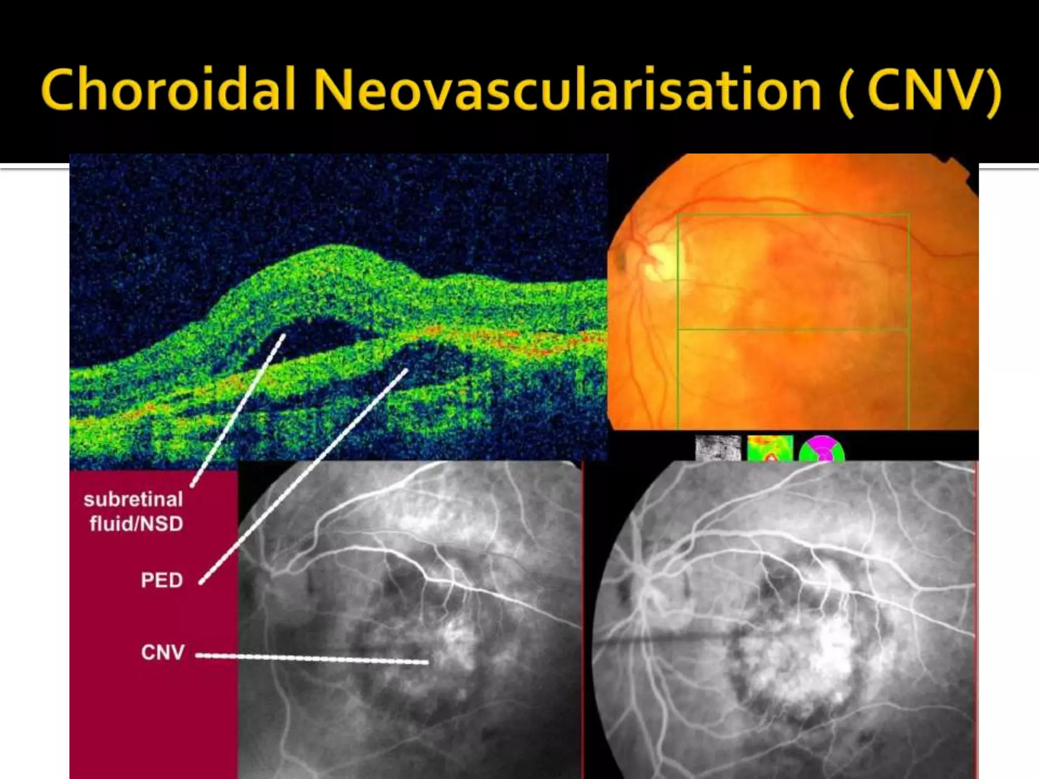 OCT – Introduction and Macular disorders | PPTX