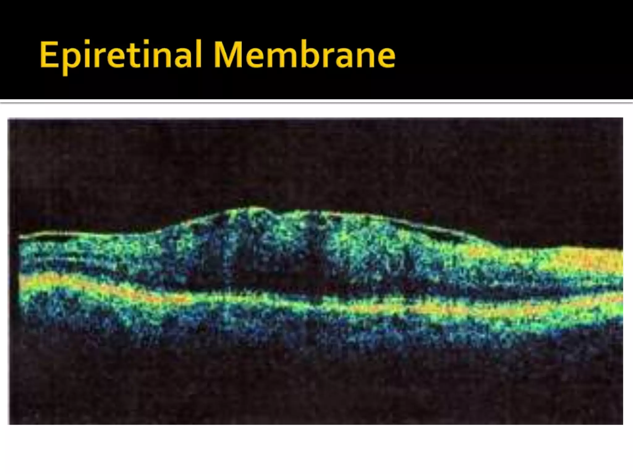 OCT – Introduction and Macular disorders | PPTX