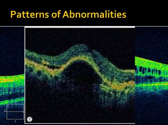 OCT – Introduction and Macular disorders | PPTX