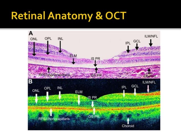 OCT – Introduction and Macular disorders | PPTX