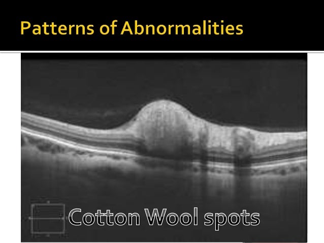 OCT – Introduction and Macular disorders