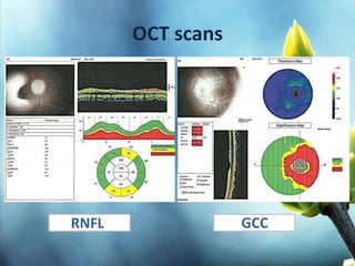 Optical Coherence Tomography in Multiple Sclerosis: a Structural ...