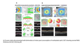 Optical Coherence Tomography (OCT) in Neurology: Diagnosis and ...