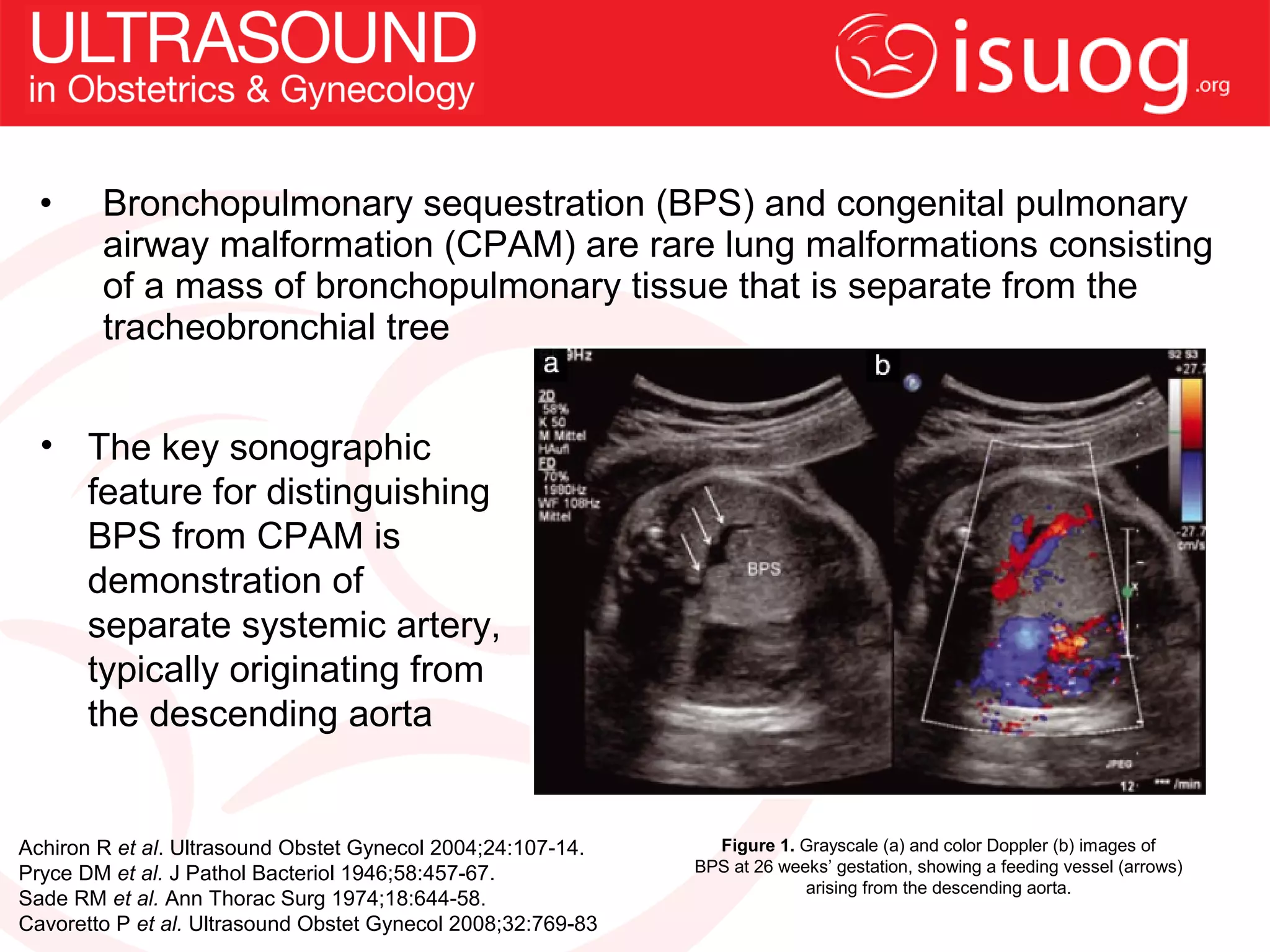 UOG Journal Club: Bronchopulmonary sequestration with massive pleural ...