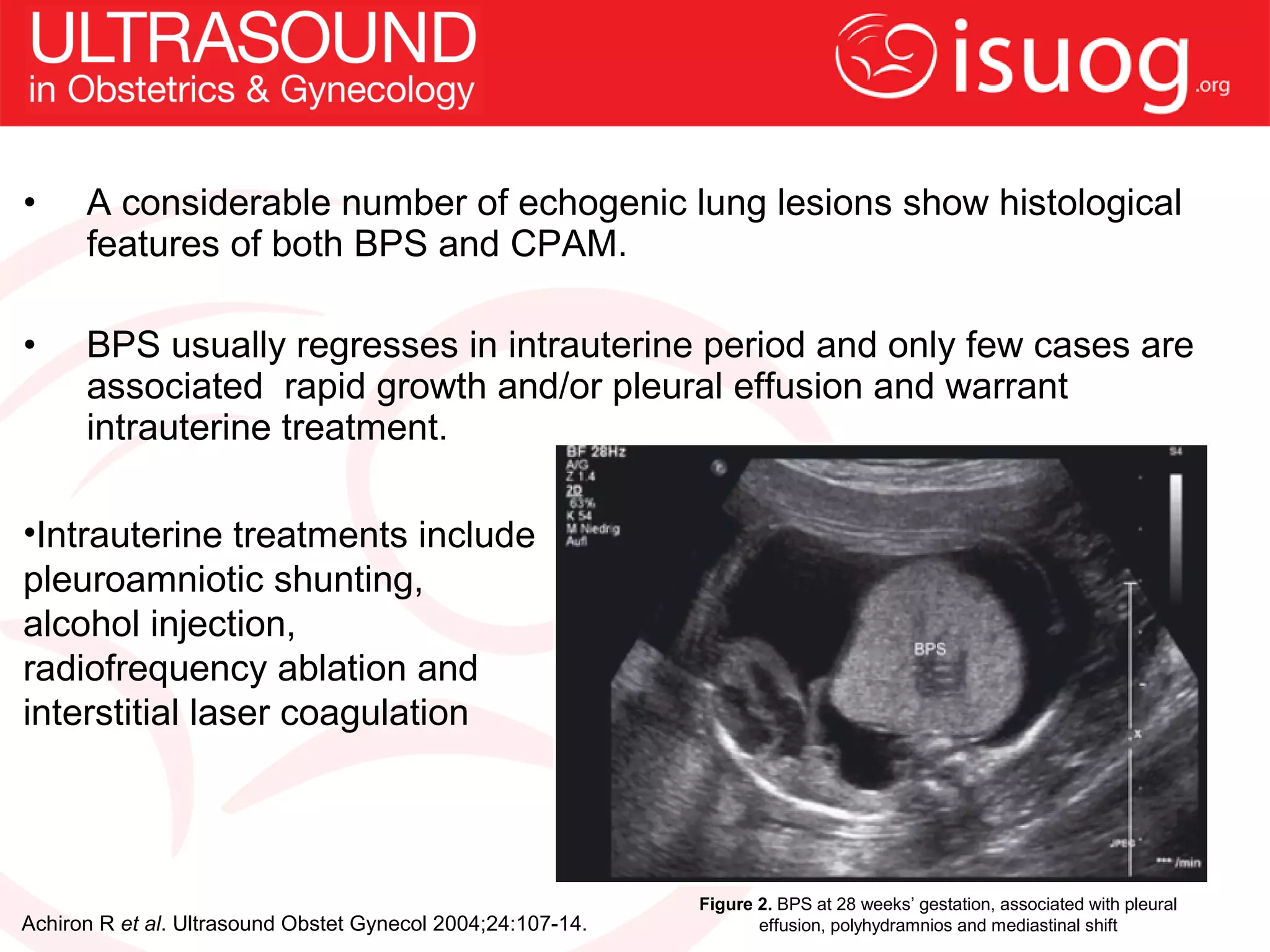 UOG Journal Club: Bronchopulmonary sequestration with massive pleural ...