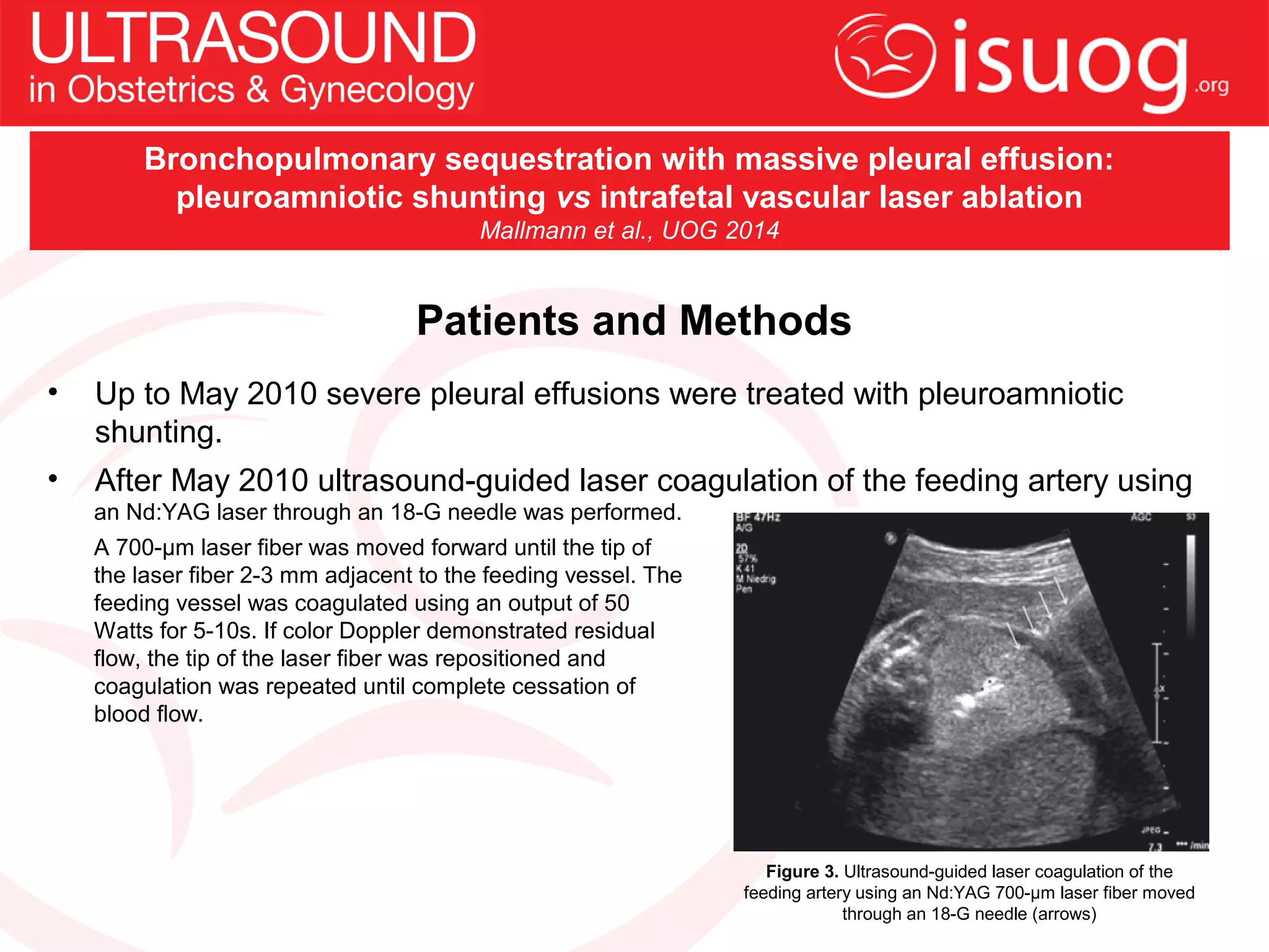 UOG Journal Club: Bronchopulmonary sequestration with massive pleural ...