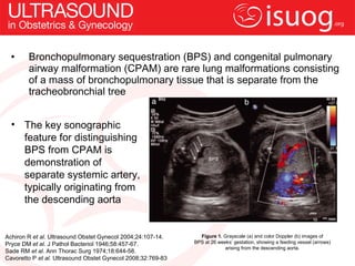 UOG Journal Club: Bronchopulmonary sequestration with massive pleural ...
