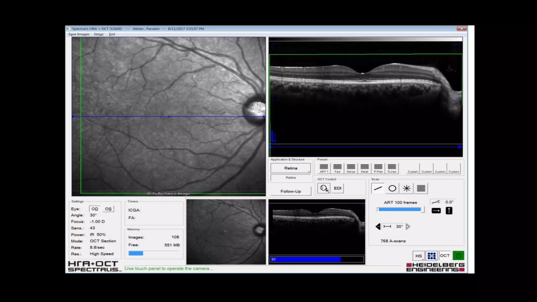 Optical Coherance Tomography (OCT) in Vitreo Retina and Choroid | PPT
