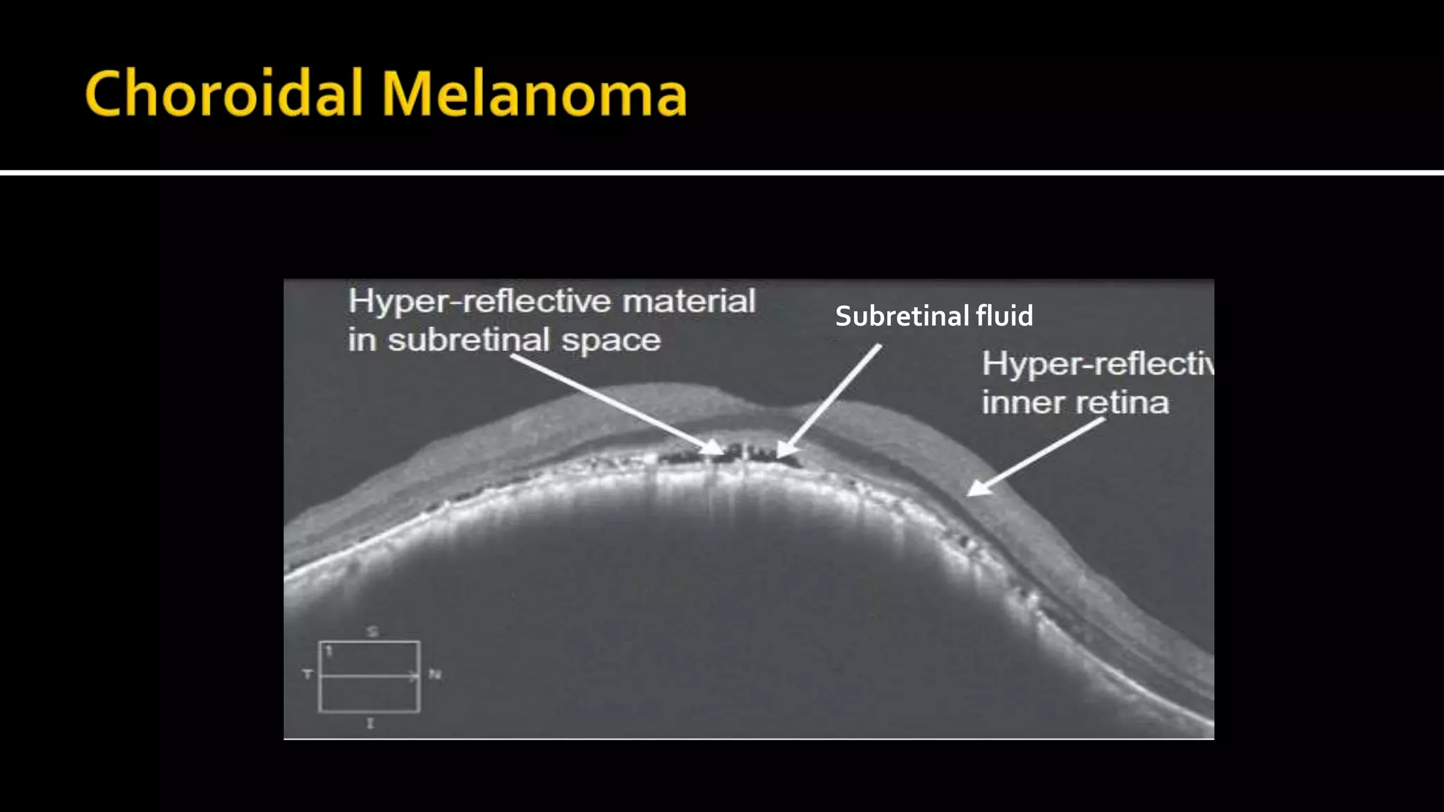 Optical Coherance Tomography (OCT) in Vitreo Retina and Choroid | PPT