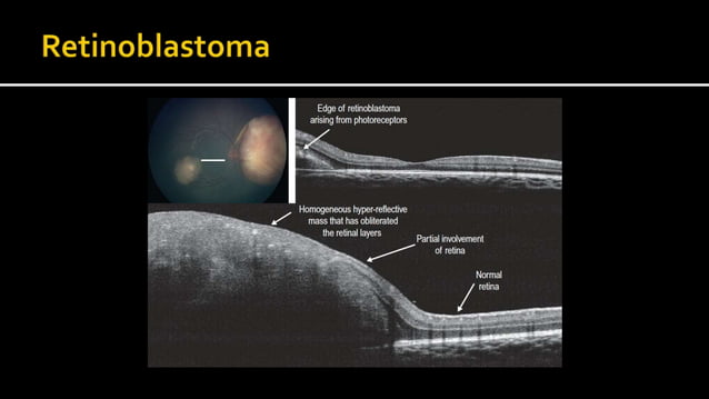 Optical Coherance Tomography (OCT) in Vitreo Retina and Choroid | PPT