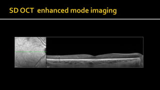 Optical Coherance Tomography (OCT) in Vitreo Retina and Choroid | PPTX
