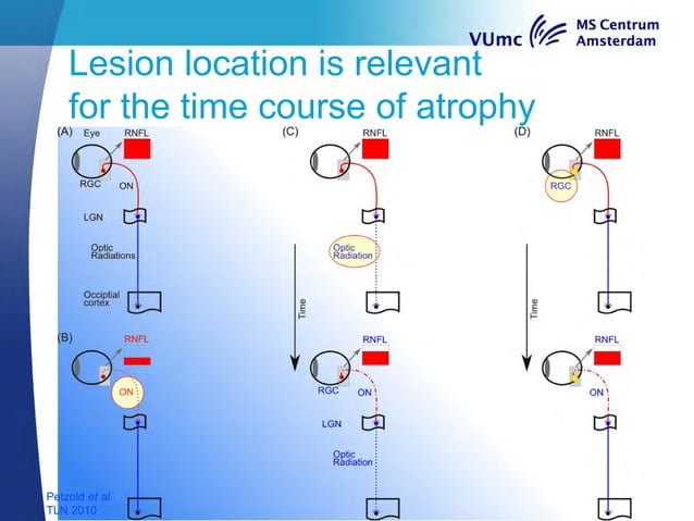 OCT tool to MS progression | PPT
