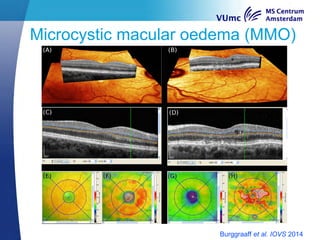 OCT tool to MS progression | PPT