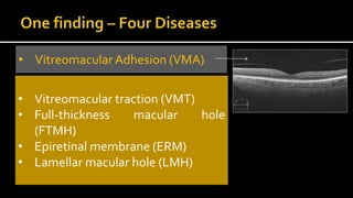OCT of Vitreomacular interface (VMI) | PPT