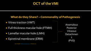 OCT of Vitreomacular interface (VMI) | PPT