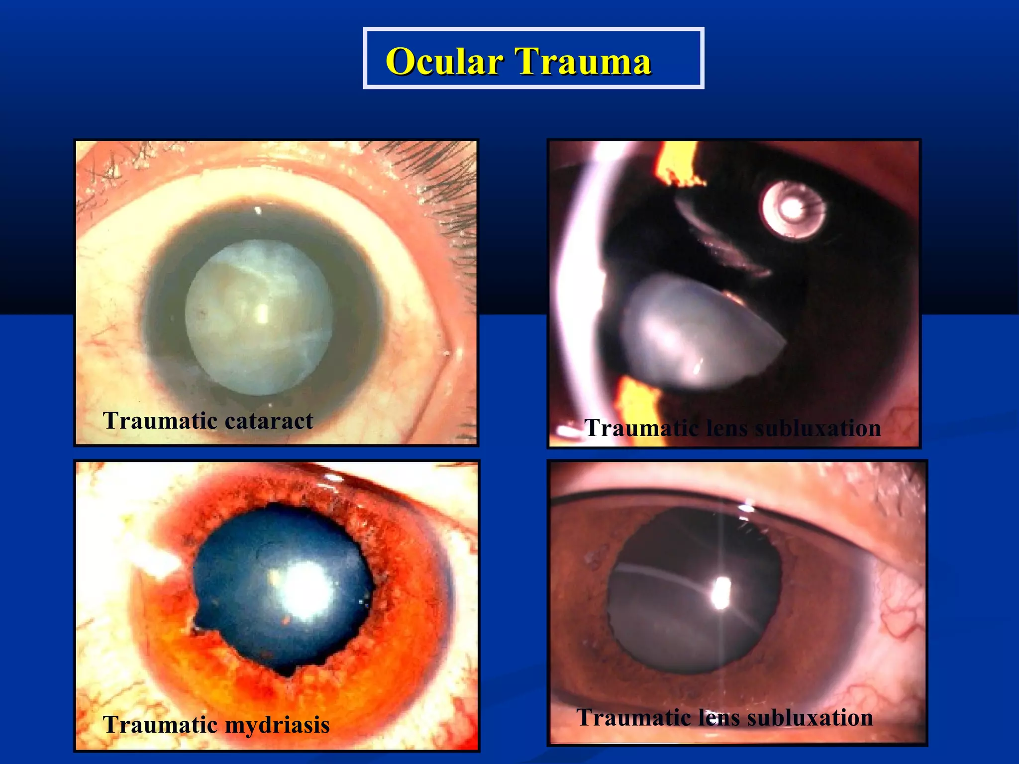 Ocular emergency- | PPT