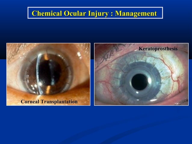 Ocular emergency- | PPT | Death, Injury, or Military Conflict ...