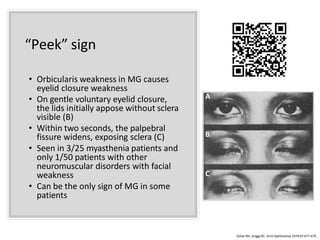 ocular-myasthenia-gravis-201118183824.pptx