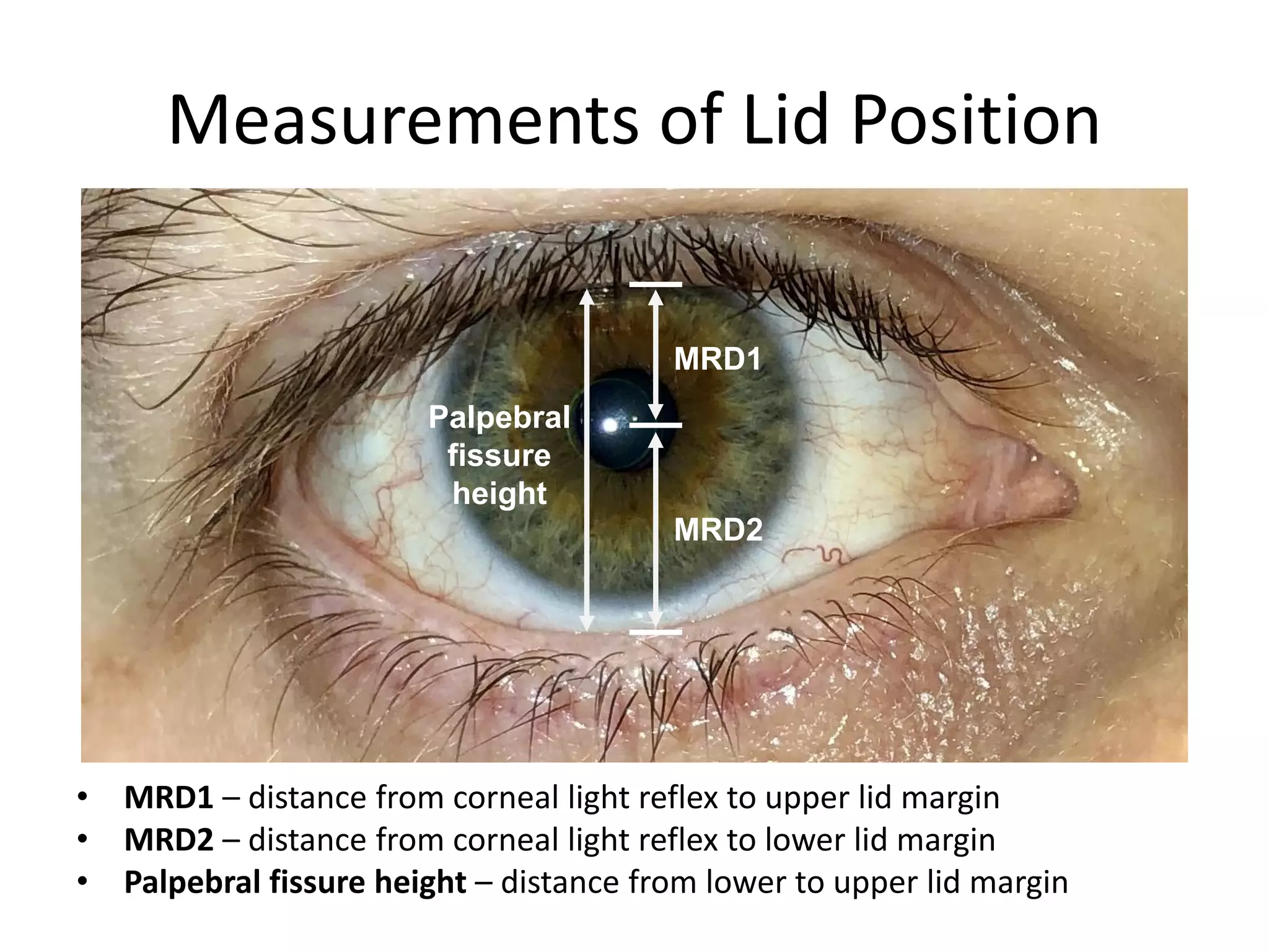 Ocular myasthenia gravis | PDF