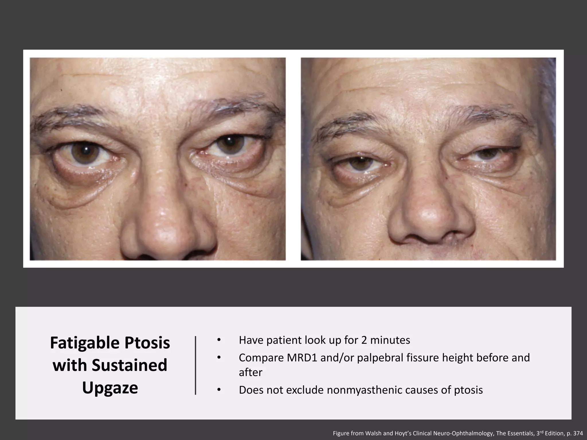 Ocular myasthenia gravis | PDF