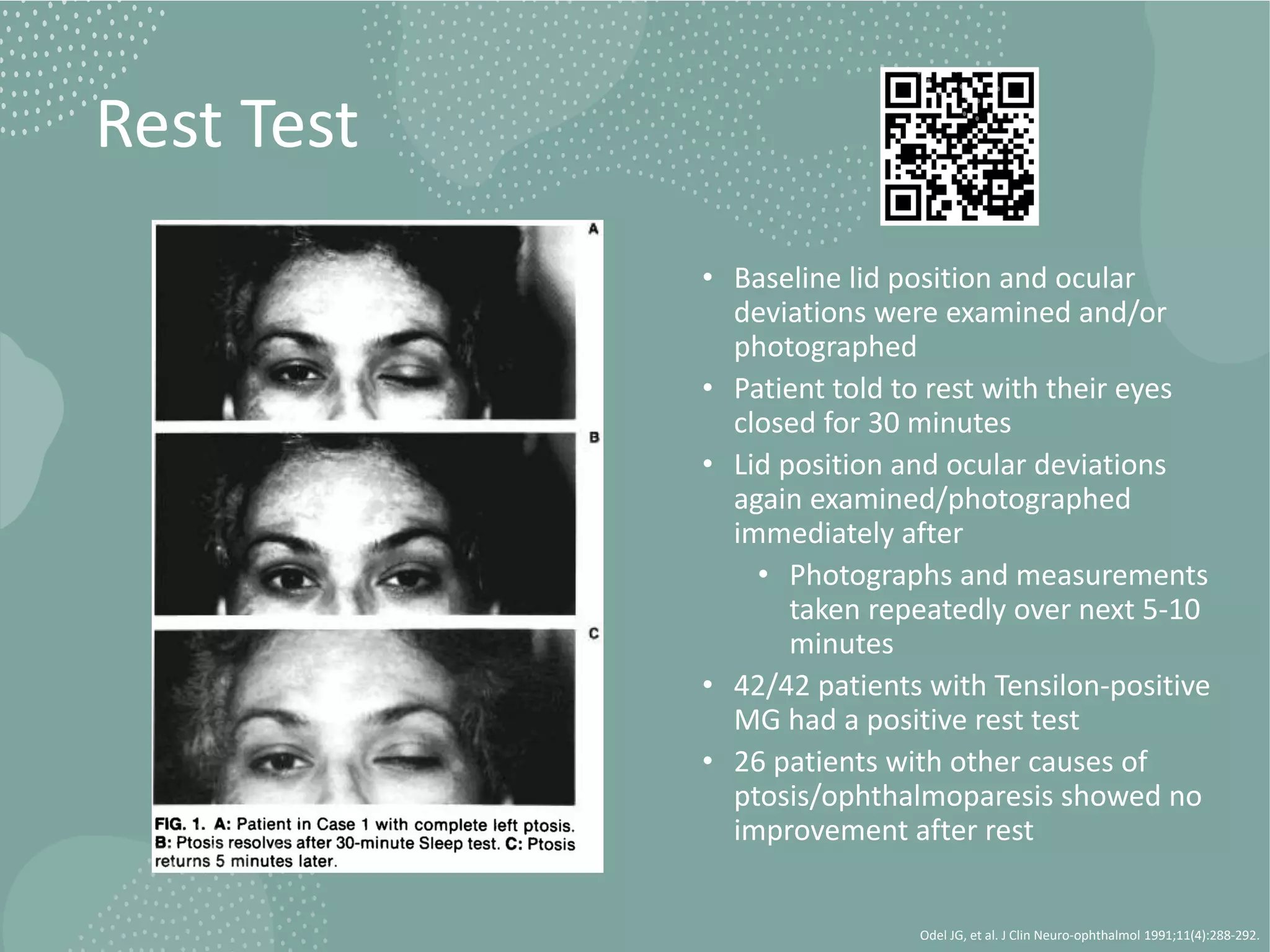 Ocular myasthenia gravis | PDF