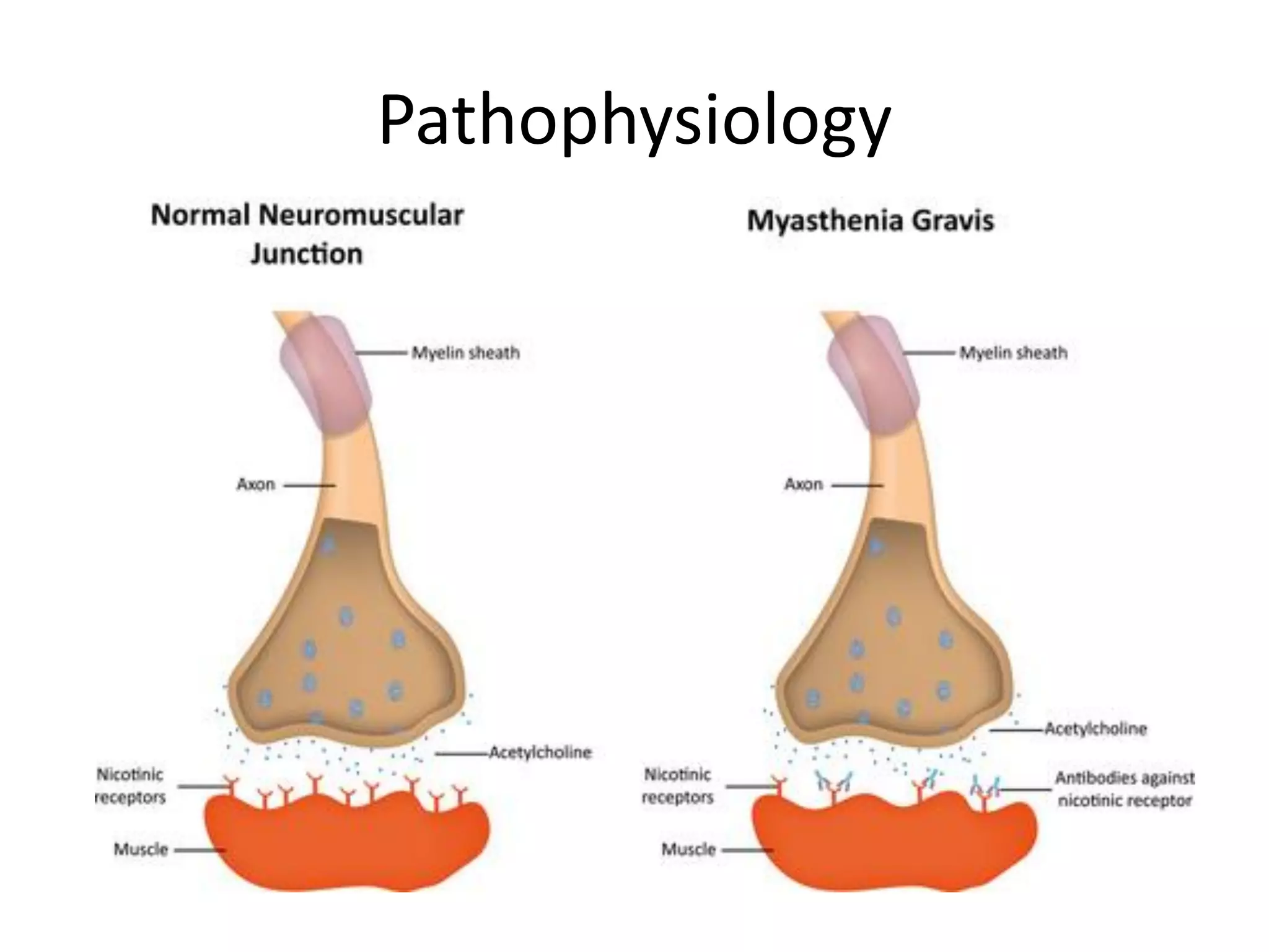 Ocular myasthenia gravis | PDF