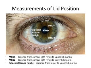 Ocular myasthenia gravis | PDF