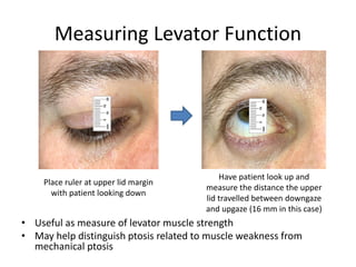 Ocular myasthenia gravis | PDF