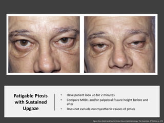 Ocular myasthenia gravis | PDF