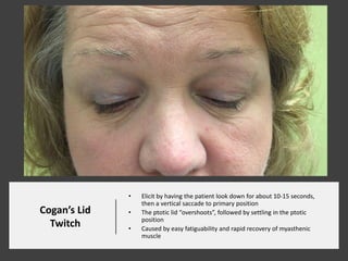 Ocular myasthenia gravis | PDF | Eye and Vision Conditions | Diseases ...