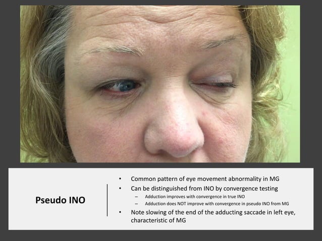Ocular myasthenia gravis | PDF | Eye and Vision Conditions | Diseases ...