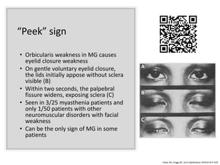 Ocular myasthenia gravis | PDF