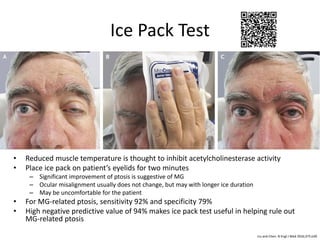 Ocular myasthenia gravis | PDF