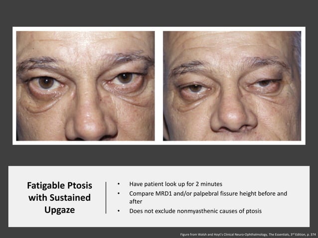 Ocular myasthenia gravis