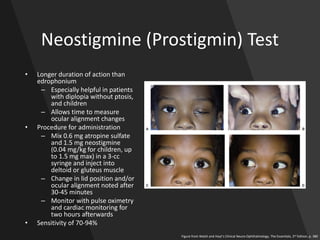 Ocular myasthenia gravis | PPT