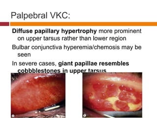Ocular allergy | PPTX