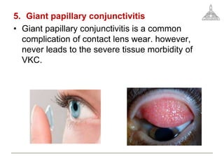 Ocular allergy | PPTX