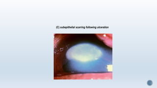 Ocular allergy rasoul amini | PPTX