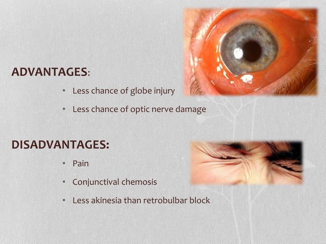 Ocular anaesthesia | PPTX