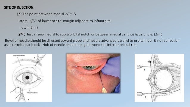 Ocular Anaesthesia Peribulbar Anaesthesia. | British Journal Of