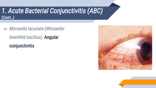 Ocular and Ear Infections and their management.pptx