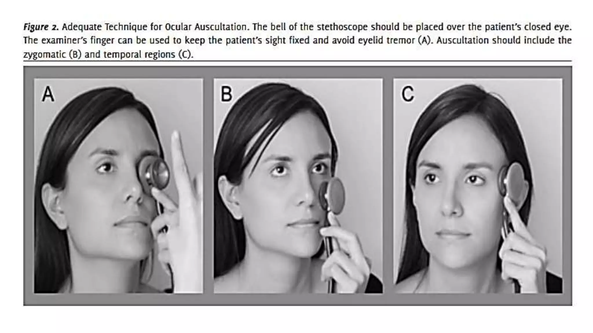 Ocular/ orbital auscultation-Technique | Ocular Bruits| Conditions ...