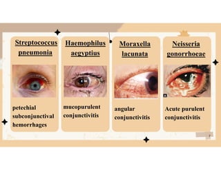 Ocular bacterial infections.pdf medical p | PDF