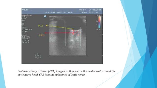 Ocular blood flow in glaucoma | PPTX | Eye and Vision Conditions ...