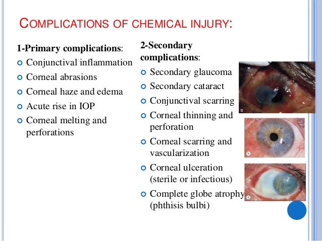 Ocular chemical injury