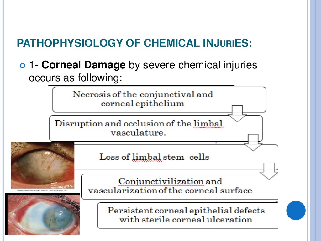 Ocular chemical injury